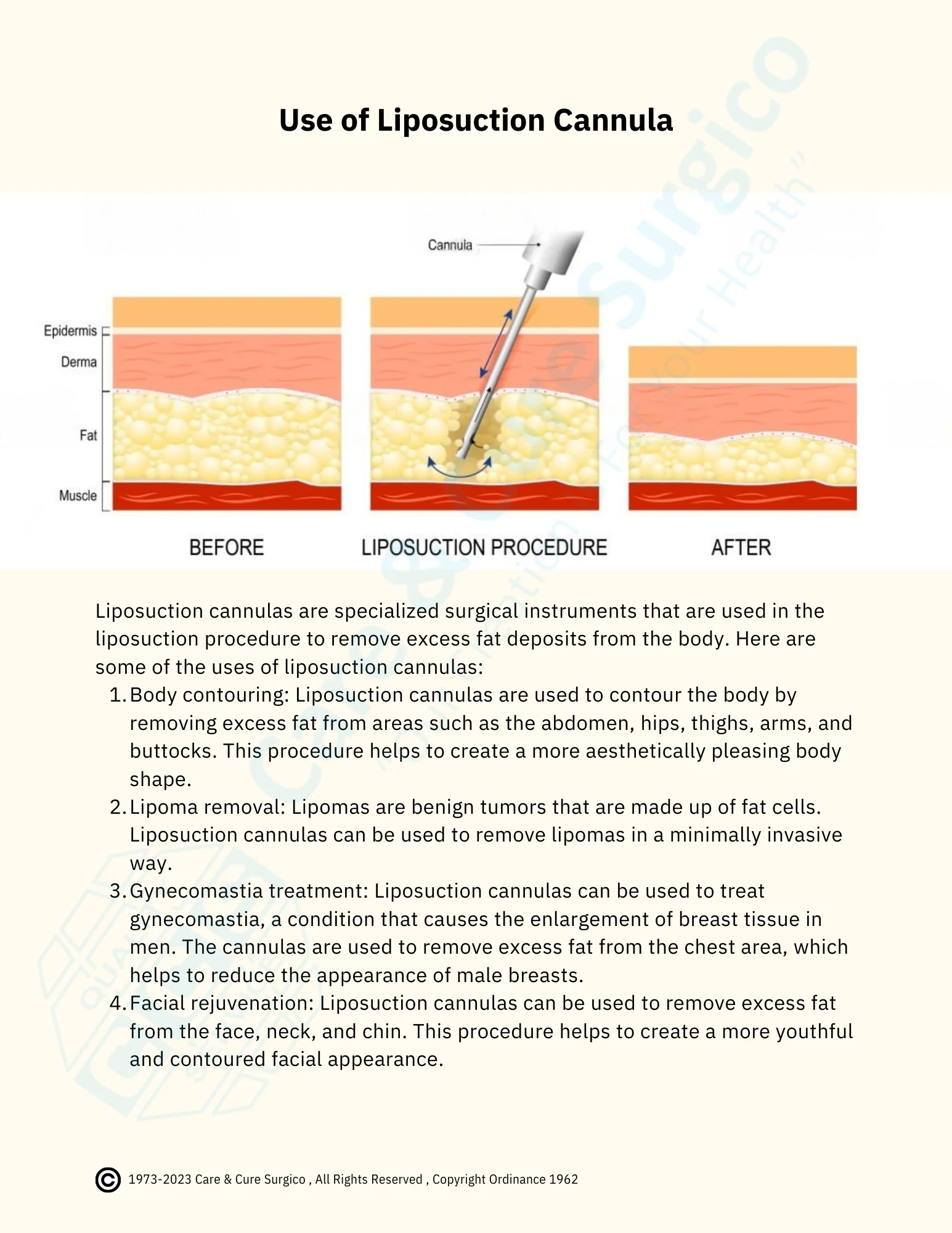 Custom Liposuction Cannula Surgery Fat Transfer Set Stainless Steel ...