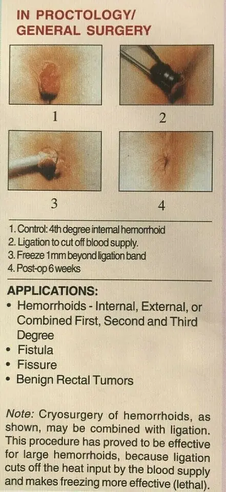 SS Manufacture Cryogun - Precision in Otorhinolaryngology and Gynecology