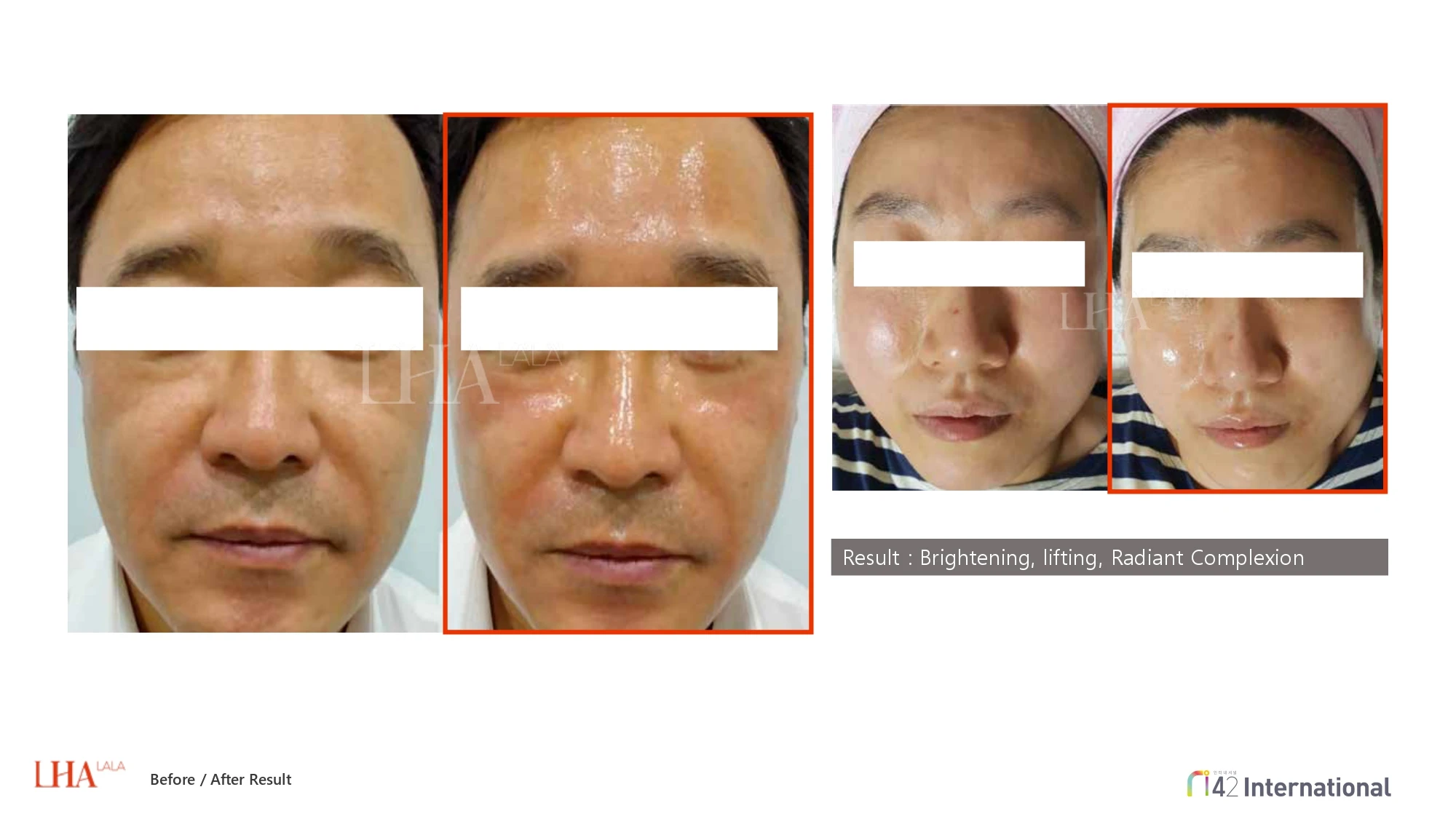 Lala Peel(basic & Ultra) Lha去角质解决方案强化皮肤的蛋白质改善肤色和提升效果 - Buy 水化改善肤色复合氨基酸矿物质维生素抗皱抗衰老透明质酸填充剂注射,皮肤再生 ...