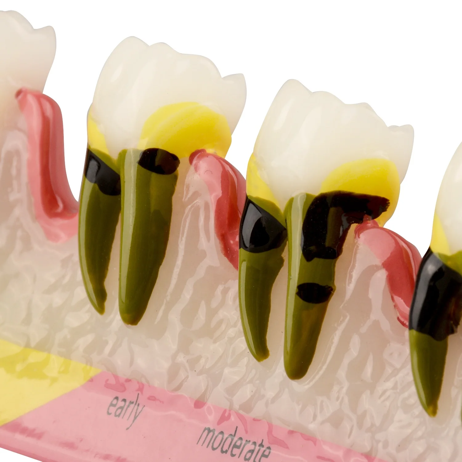 Periodontal Disease Classification Symptoms Stages Model To Show The ...