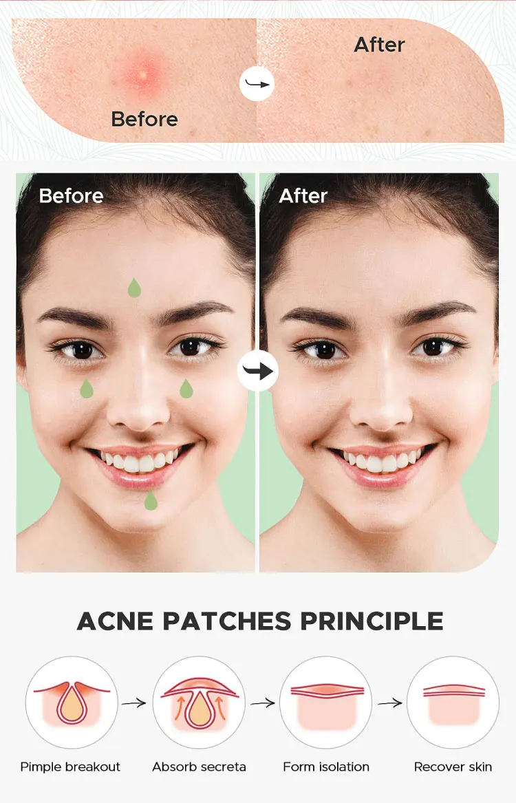 Cure Acne Pimple Hydrocolloid Sticker Pimple Patches and Spot Plaster ...
