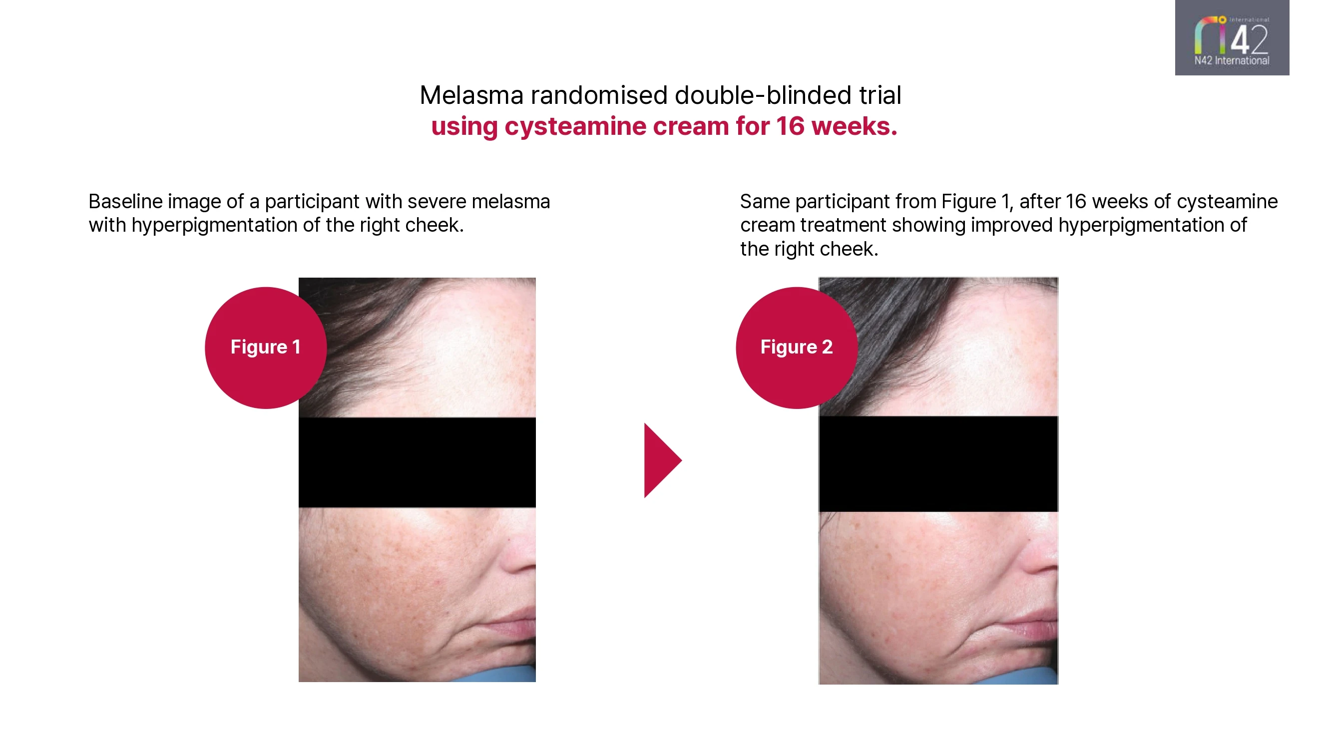 Made In Korea Fomellacys Odt Cream Pack Effect For Removing Melasma And ...