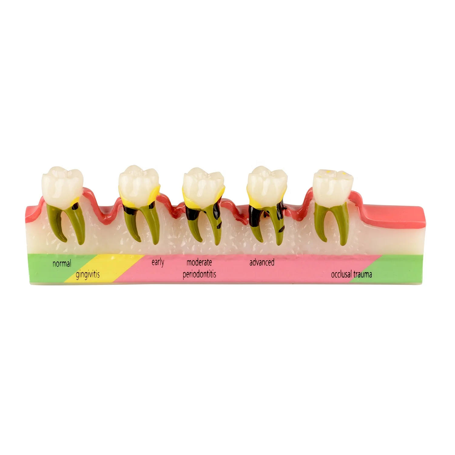 Periodontal Disease Classification Symptoms Stages Model To Show The ...