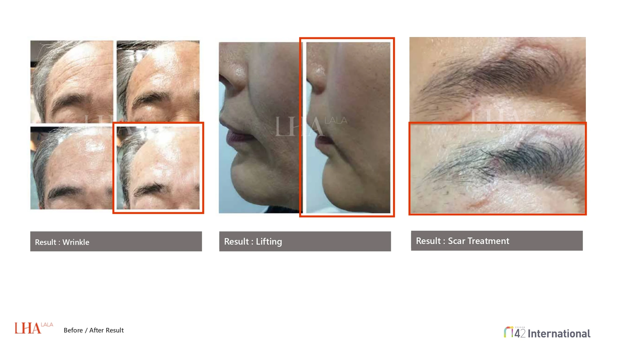 Lala Peel(basic & Ultra) Lha Peeling Solution For Skin Strengthening ...