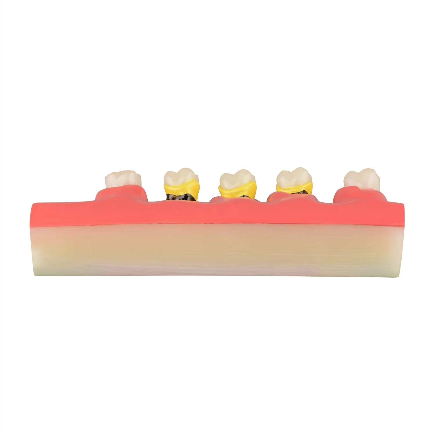 Periodontal Disease Classification Symptoms Stages Model to Show the ...