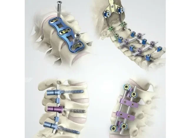 Cervical Intervertebral Fusion Cage System Peek Orthopedic Implant For ...