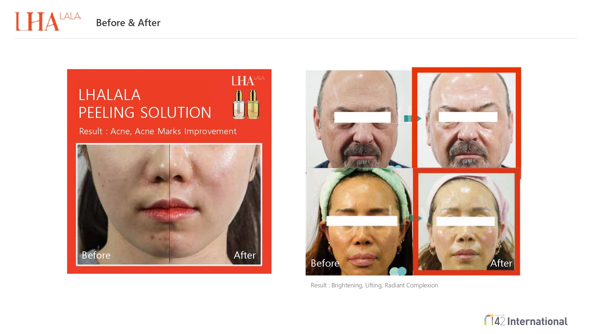 Lala Peel(basic & Ultra) Lha Peeling Solution For Skin Strengthening ...