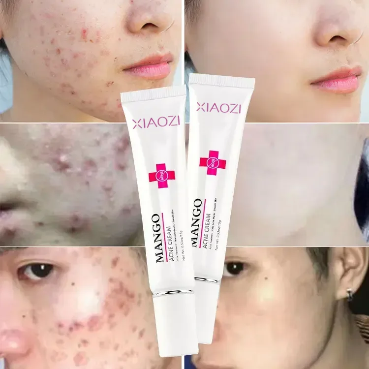 Anti Acne Cream Acne Removing Cream Pore Shrink Rapid Spot Treatment Moisturizing Soothing Face ...