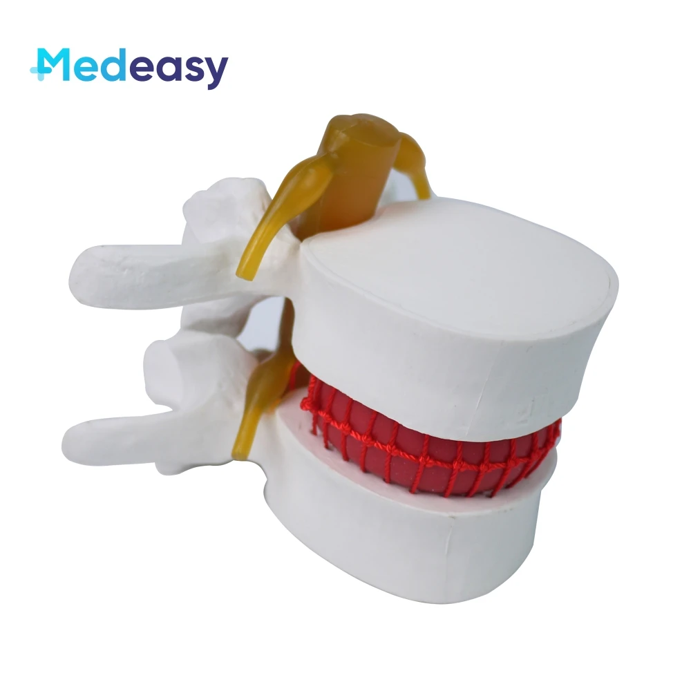 Lumbar Disc Herniation Model - Educational Anatomical Tool