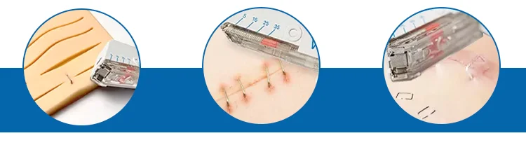 Fresh Goods Disposable Skin Stapler - CE Certified