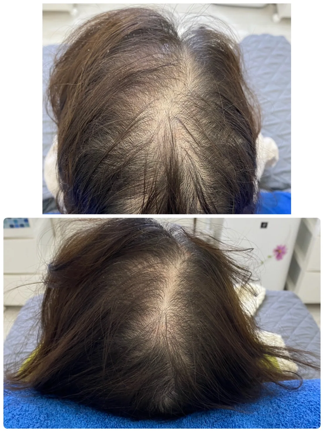 Made In Japan Scalp Wate Hair Problems. Super Rough 100 Scalp Water ...