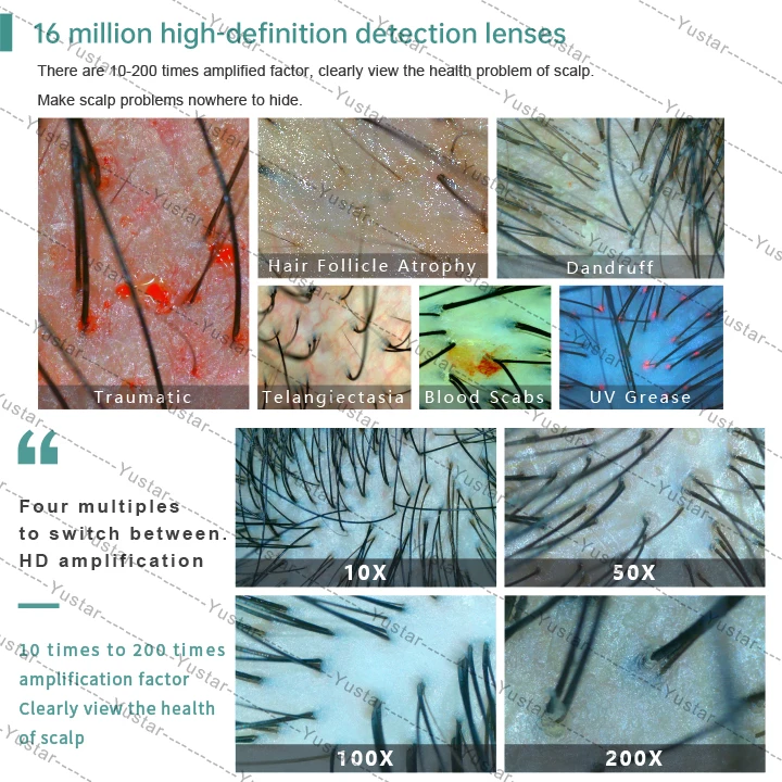 Professional Medical Commercial Scalp Analyzer Hair Follicle Detector ...