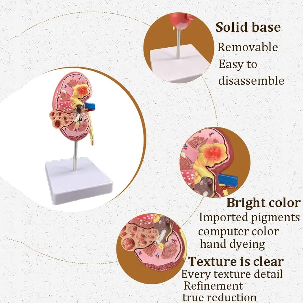 Pathology Kidney Model Dual Perspective With Normal And Diseased Kidney ...