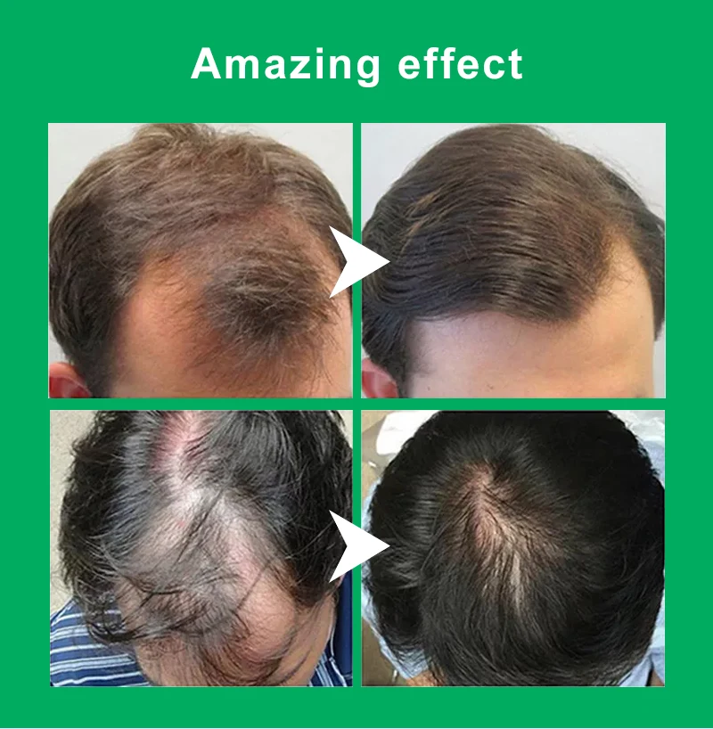 Best Oil for Bald Head - Promotes Hair Growth & Repair