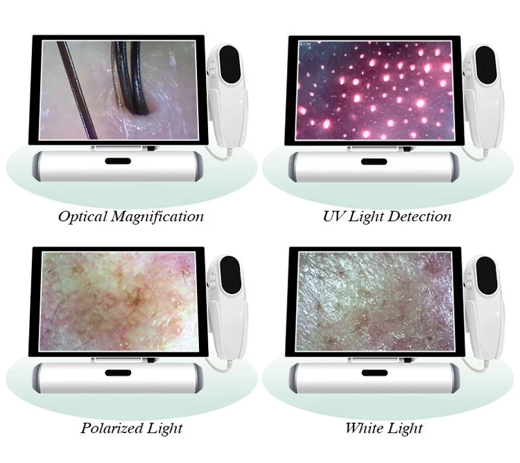 USB Digital Hair Transplant Microscope - 3D Dermatoscope