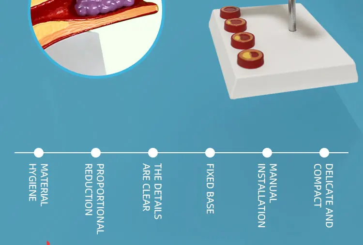 Artery and Blood Vessel Model - Understanding Atherosclerosis