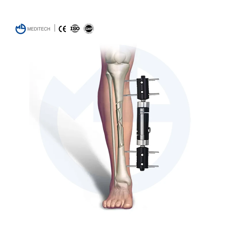 Czmeditech Hybride Biplan Uniplan Ao Jambe Delta Mini T Pince Taylor ...