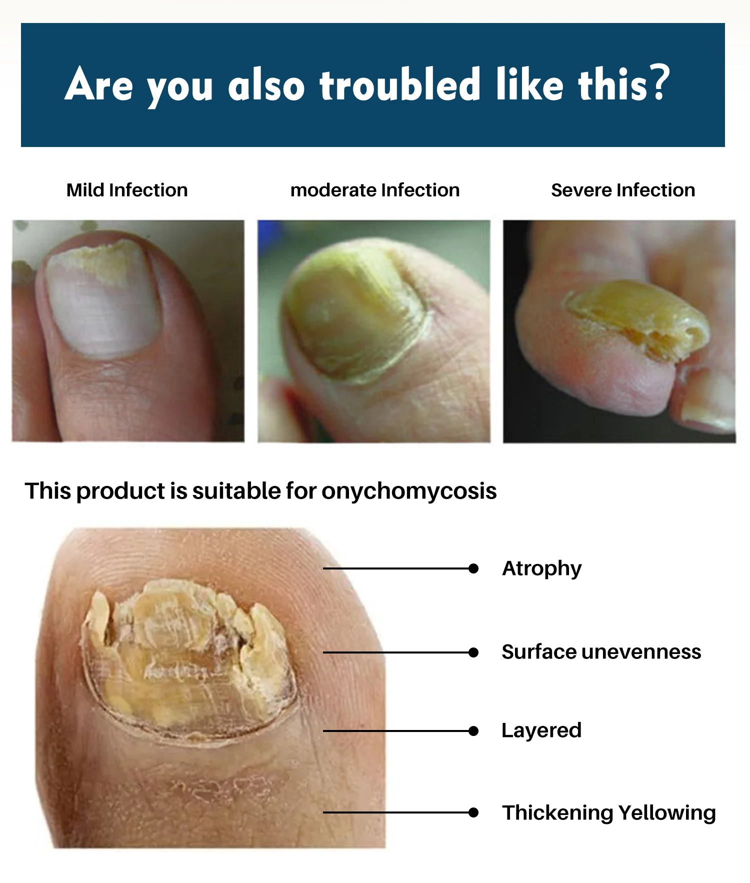 Lanthome Nail Fungus Removal Cream - Herbal Anti-Infection Ointment for ...