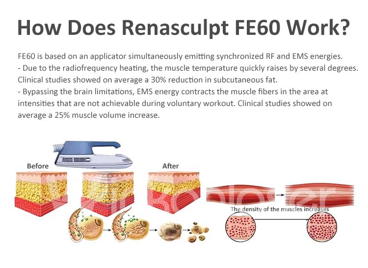 2022 Renasculpt Ems Neo Rf Max 5 Handle 10 Tesla Emslim Neo Body Sculpt ...