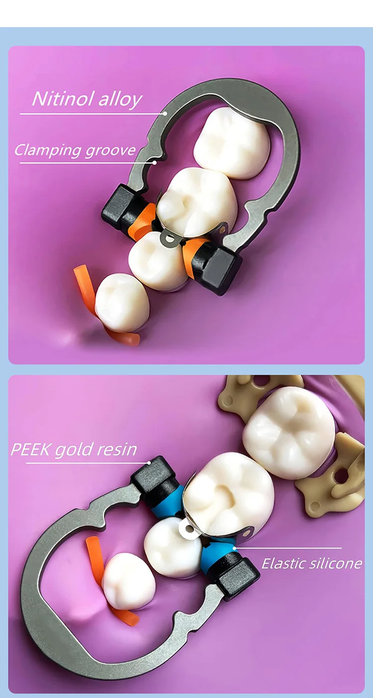 Dental Tools Matrix Clip Separating Ring Niti Spring Clamping Ring R5 1 ...