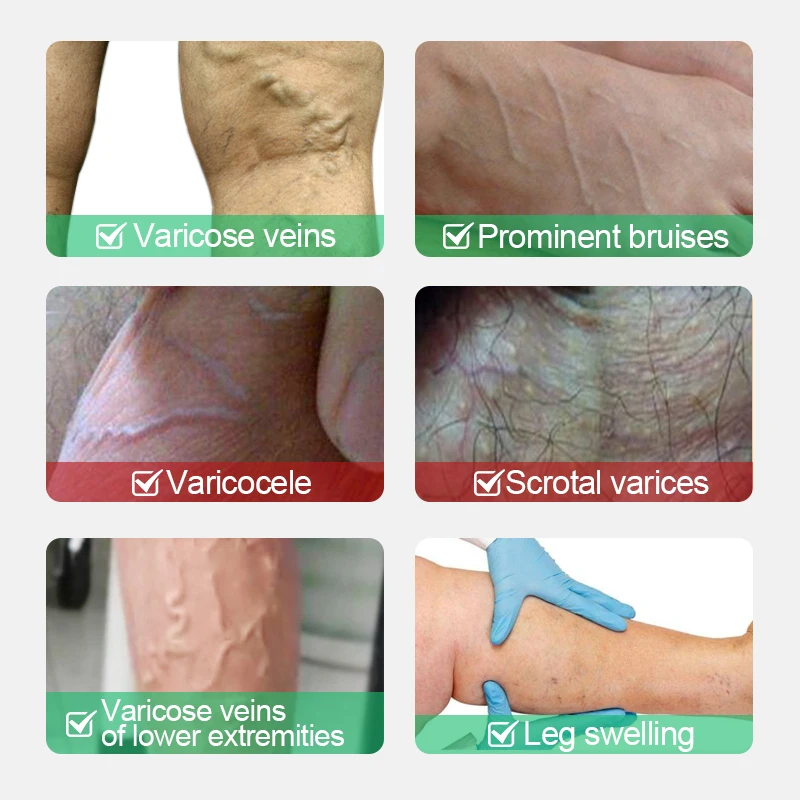Kanyehb Genital Scrotum Varicocele Remover Treatment Varicose Veins Cream Varicosity Angiitis 