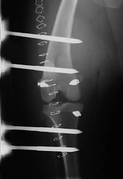 Titanium Anchors for Ligament Joint Repair - Durable Orthopedic ...