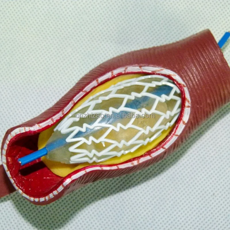 Human Blood Vessel Magnification Blockage Model Blood Vessel Stent ...