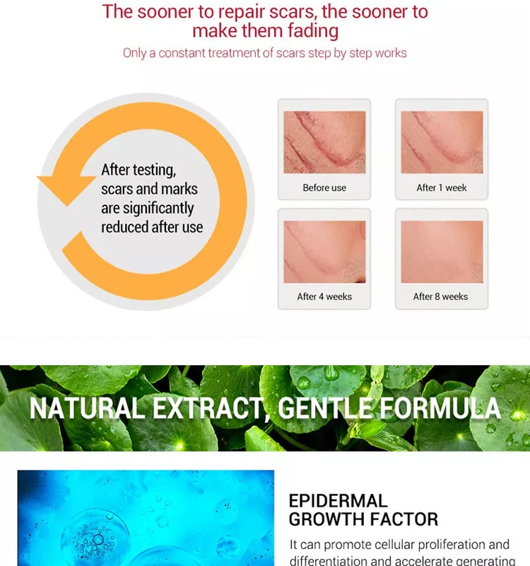 Strong Effective Acne Scar Removal Cream Pimples Stretch Mark Remove ...