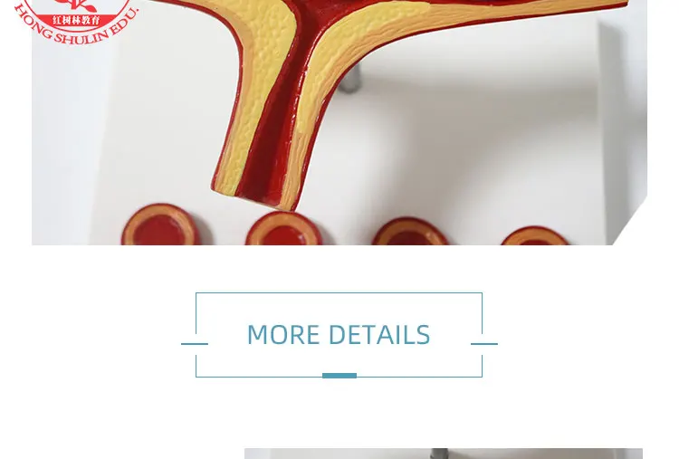 Artery and Blood Vessel Model - Understanding Atherosclerosis