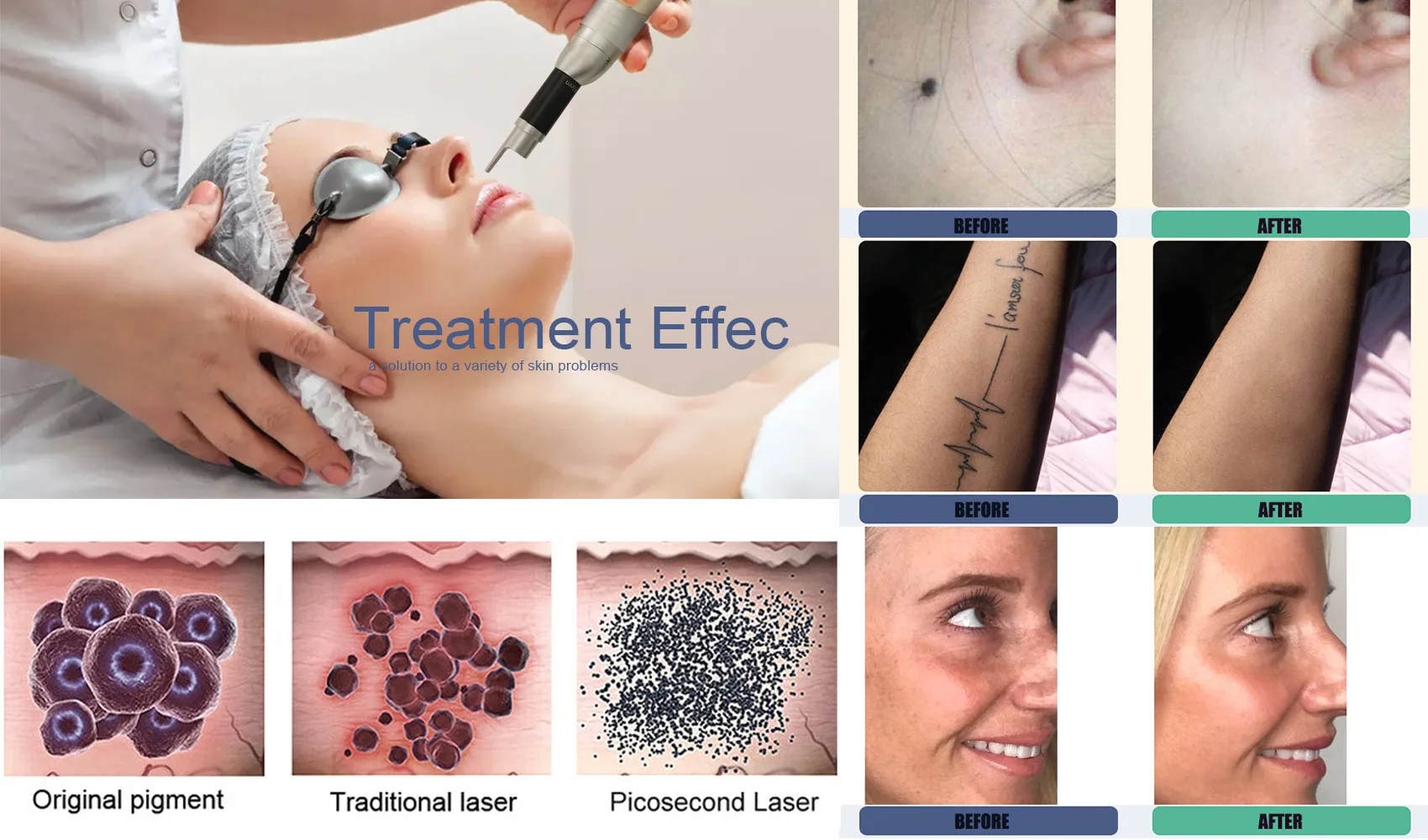 Laser Beauty Equipment Picosecond Laser Tattoo Removal Machines Removal ...