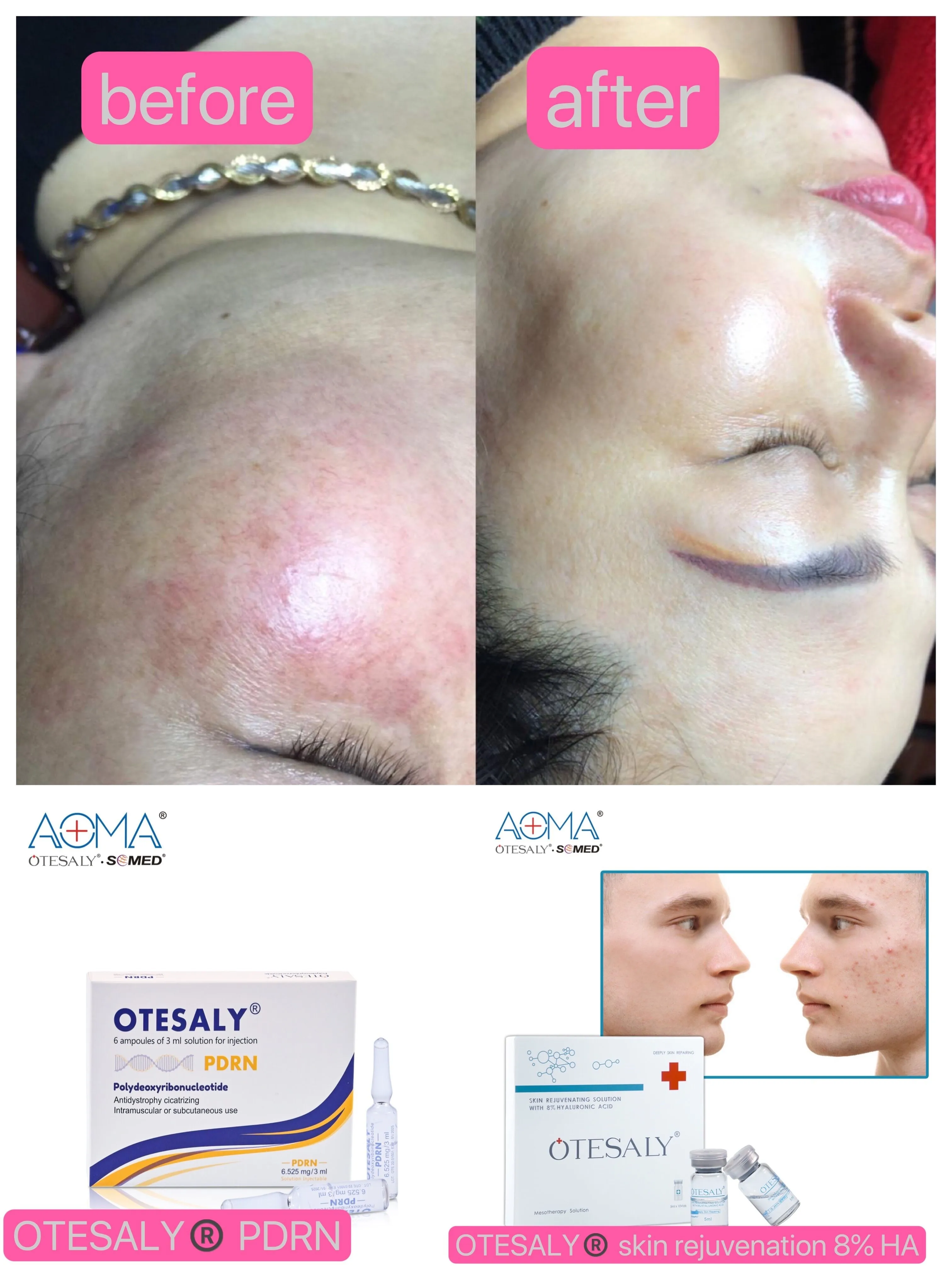 Otesaly Aoma Otesaly Meso Pdrn Skin Rejuvenating Serum For Anti ... Otesaly Aoma Otesaly Meso Pdrn Skin Rejuvenating Serum For Anti ...