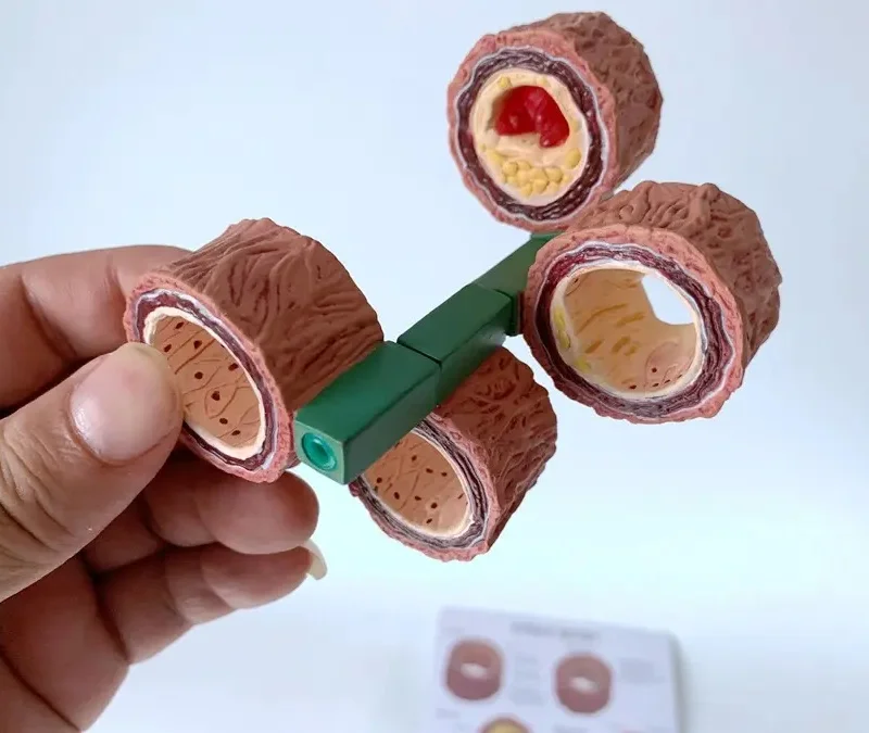 Human Artery Atherosclerosis Model - Anatomical Vascular Disease ...