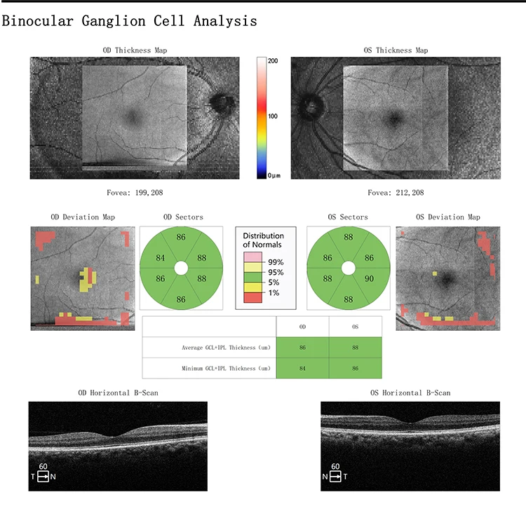 Oct-500 Glaucoma Eye Detector Optical Coherence Tomography Oct Machine ...