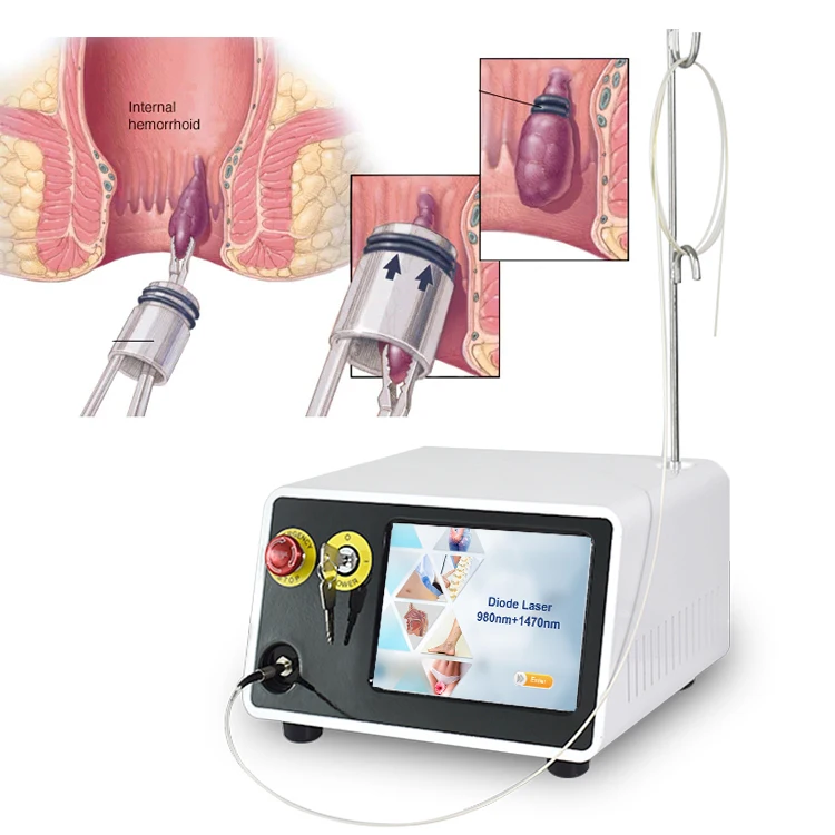 Fistula Rectal Proctology Hemorrhoids Laser Anorectal Department 980nm ...