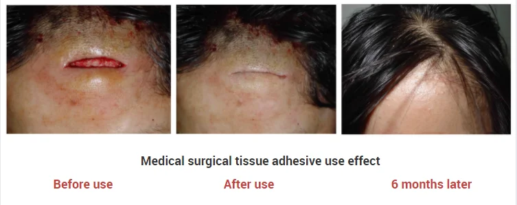 Topical Skin Adhesive For Optimal Wound Closure - Buy Topical Skin ...