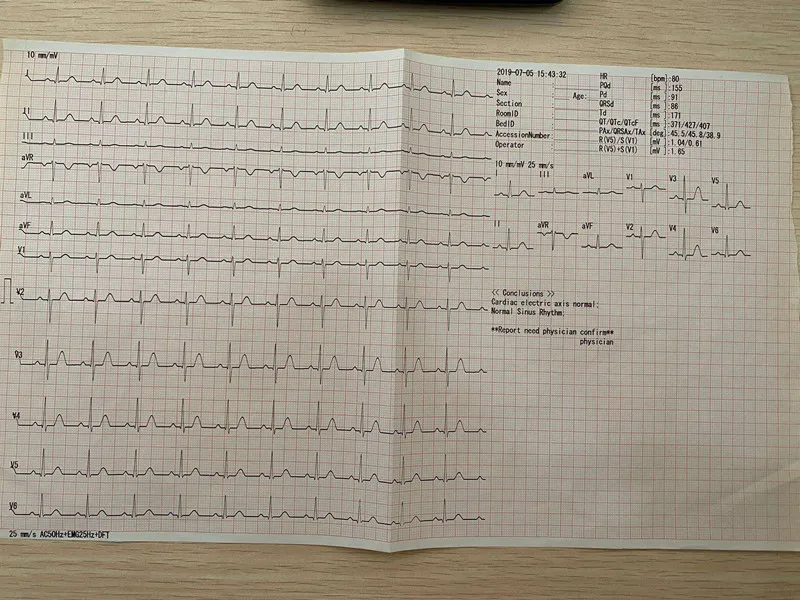 MSL EKG ECG Machine - 12 Channel Holter with 1000hz Sampling