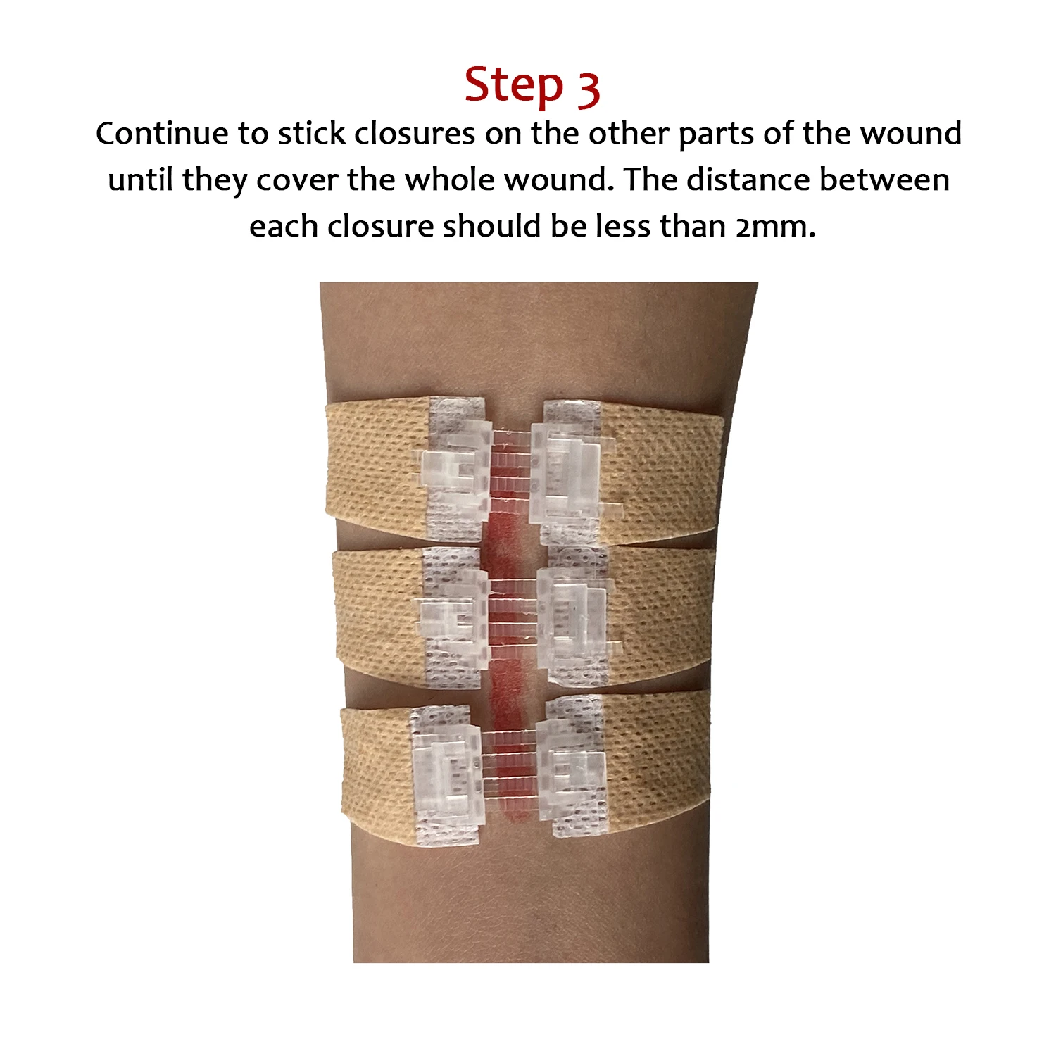 Zip Stitch Sutures - Waterproof Wound Closure Strips