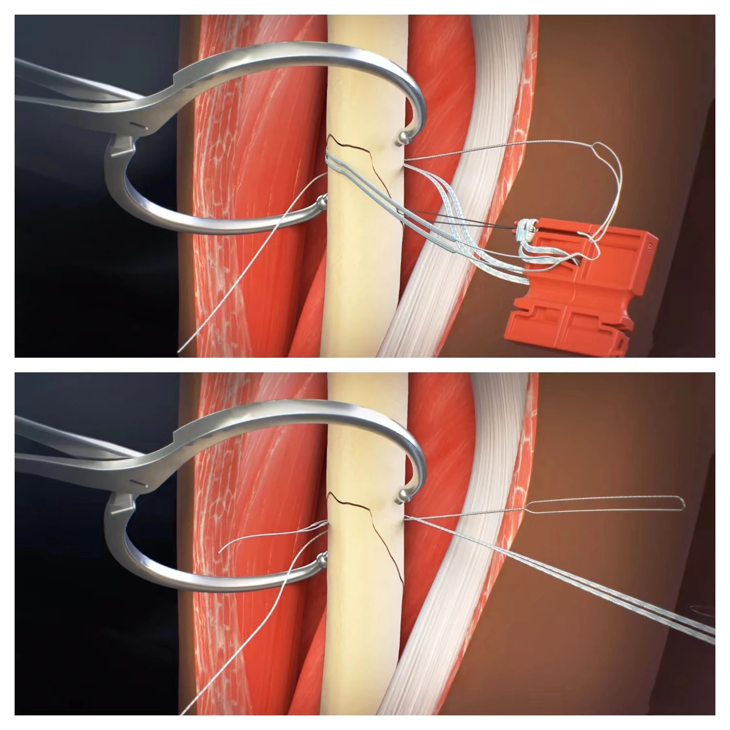 UHMWPE Suture Thread for PCL - High Tenacity & Strength