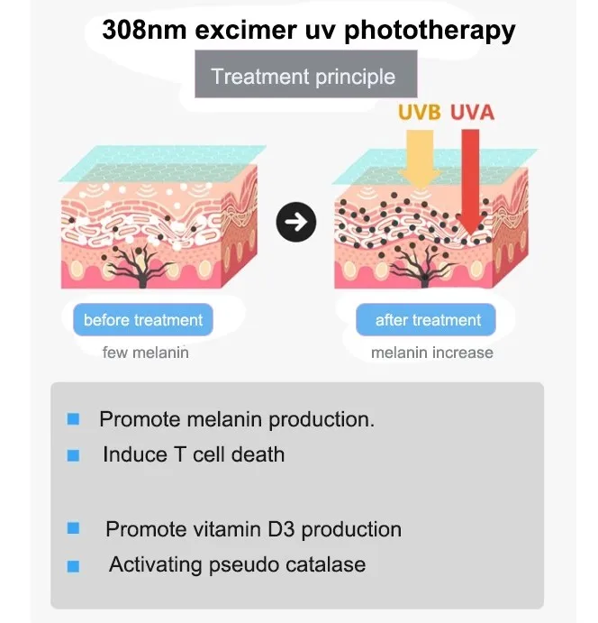 308nm Psoriasis Vitiligo Ultraviolet Excimer System Laser For Small Area Treatment/hospital ...
