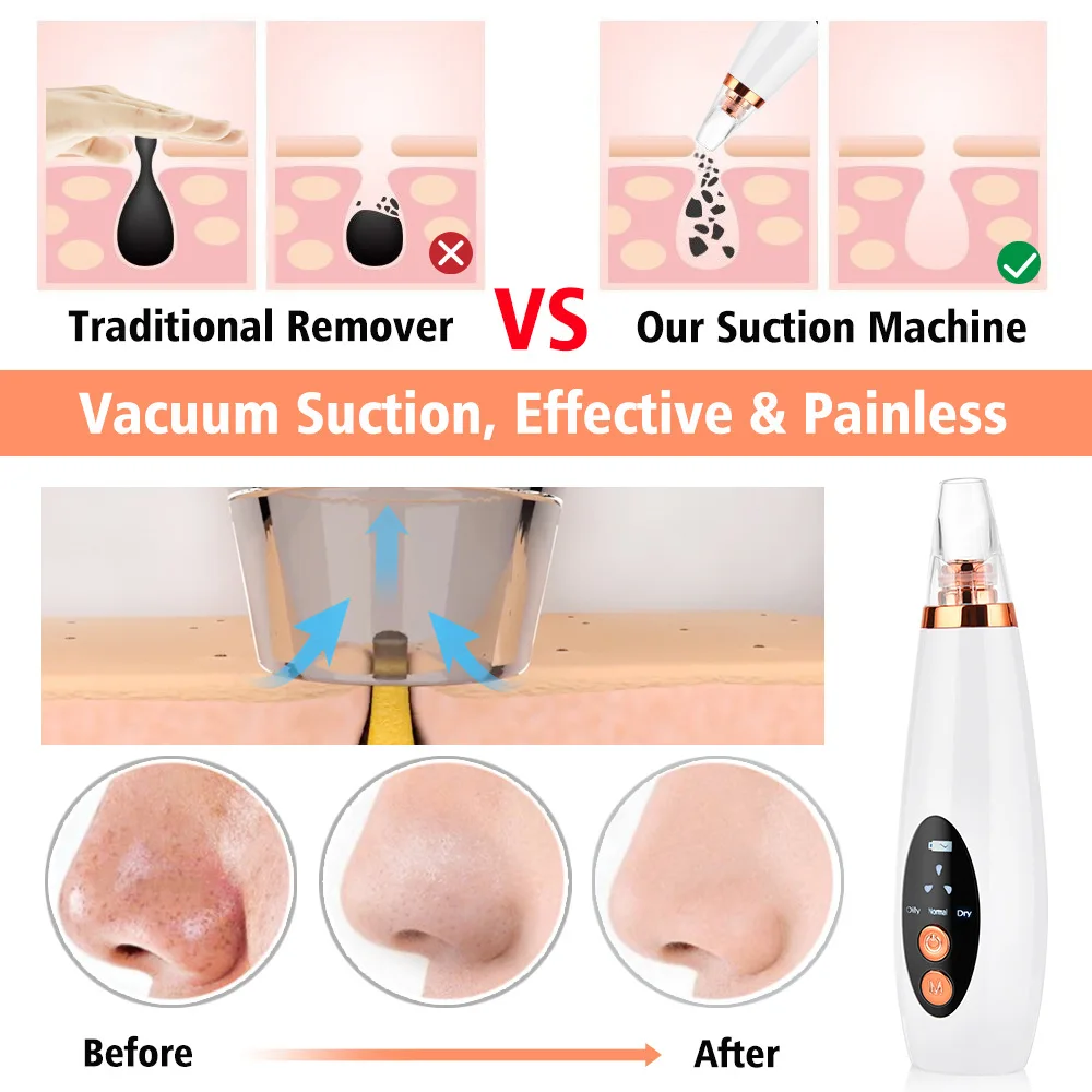 6 Suction Heads Rechargeable Facial Pore Deep Cleansing Tool Pimple ...