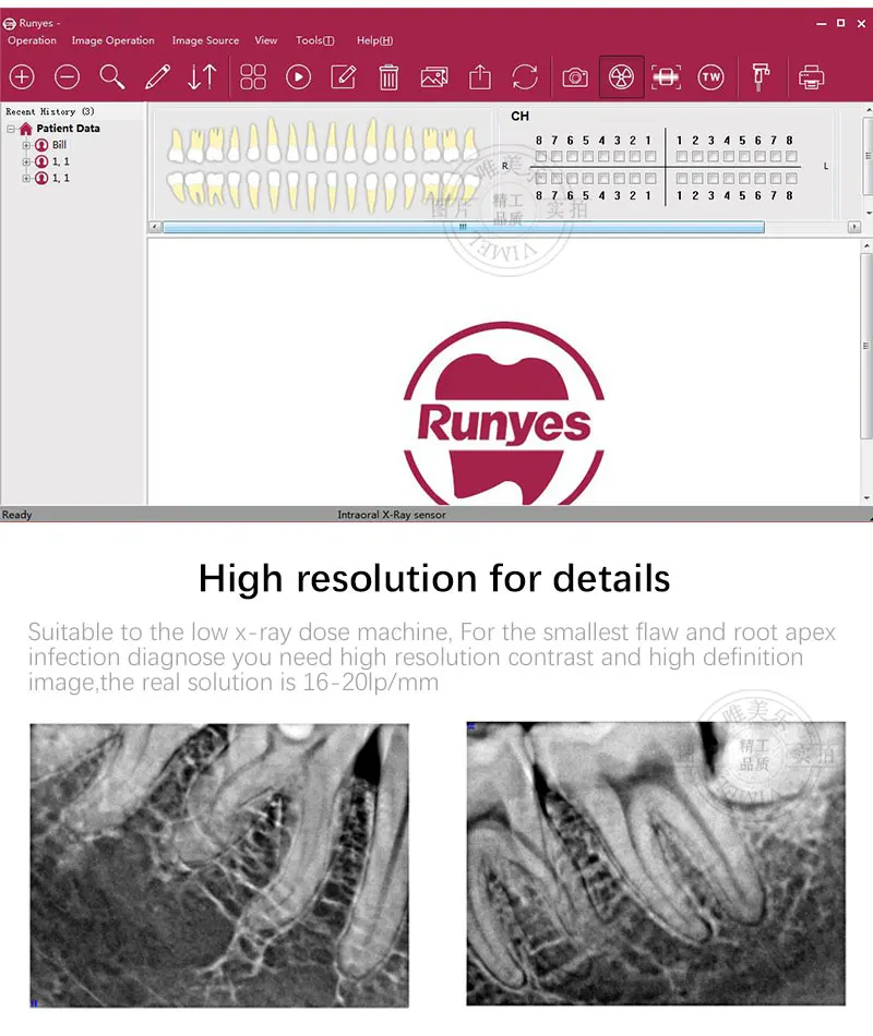Medical Equipment Intraoral Imaging Digital X-ray Sensor Runyes Dental ...