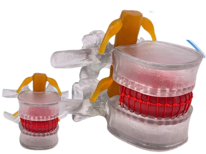 Lumbar Spine Magnification Lumbar Disc Compression Demonstration Model ...