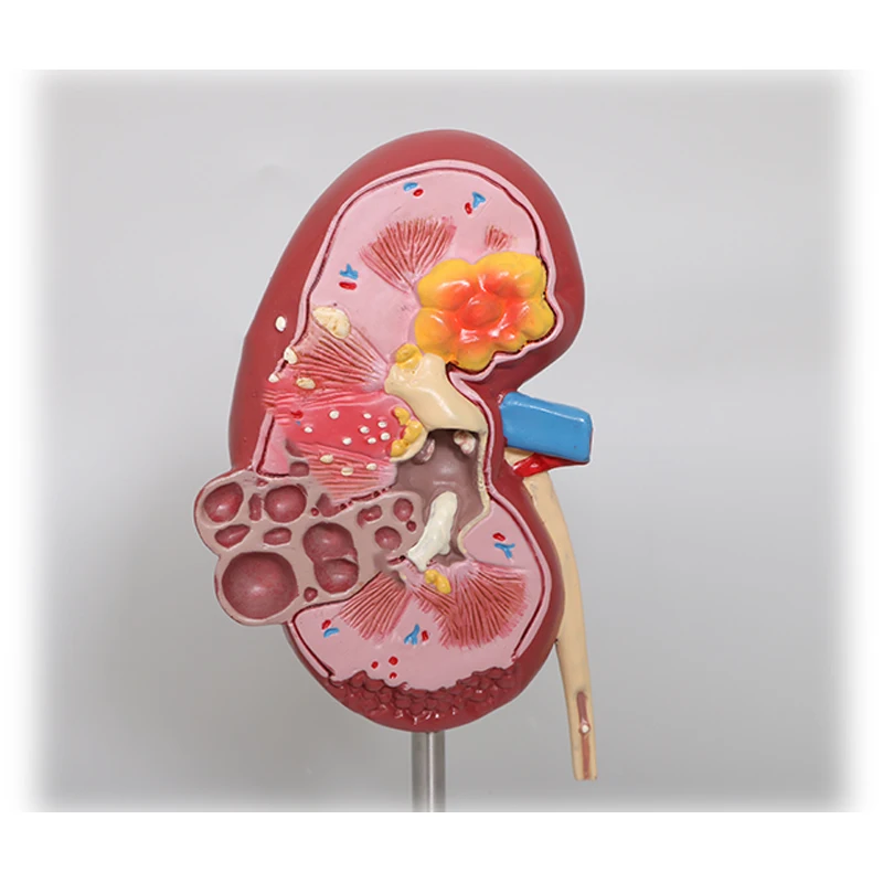 Human Kidney Anatomy Model Anatomy Urology Special Renal Lesion Model ...