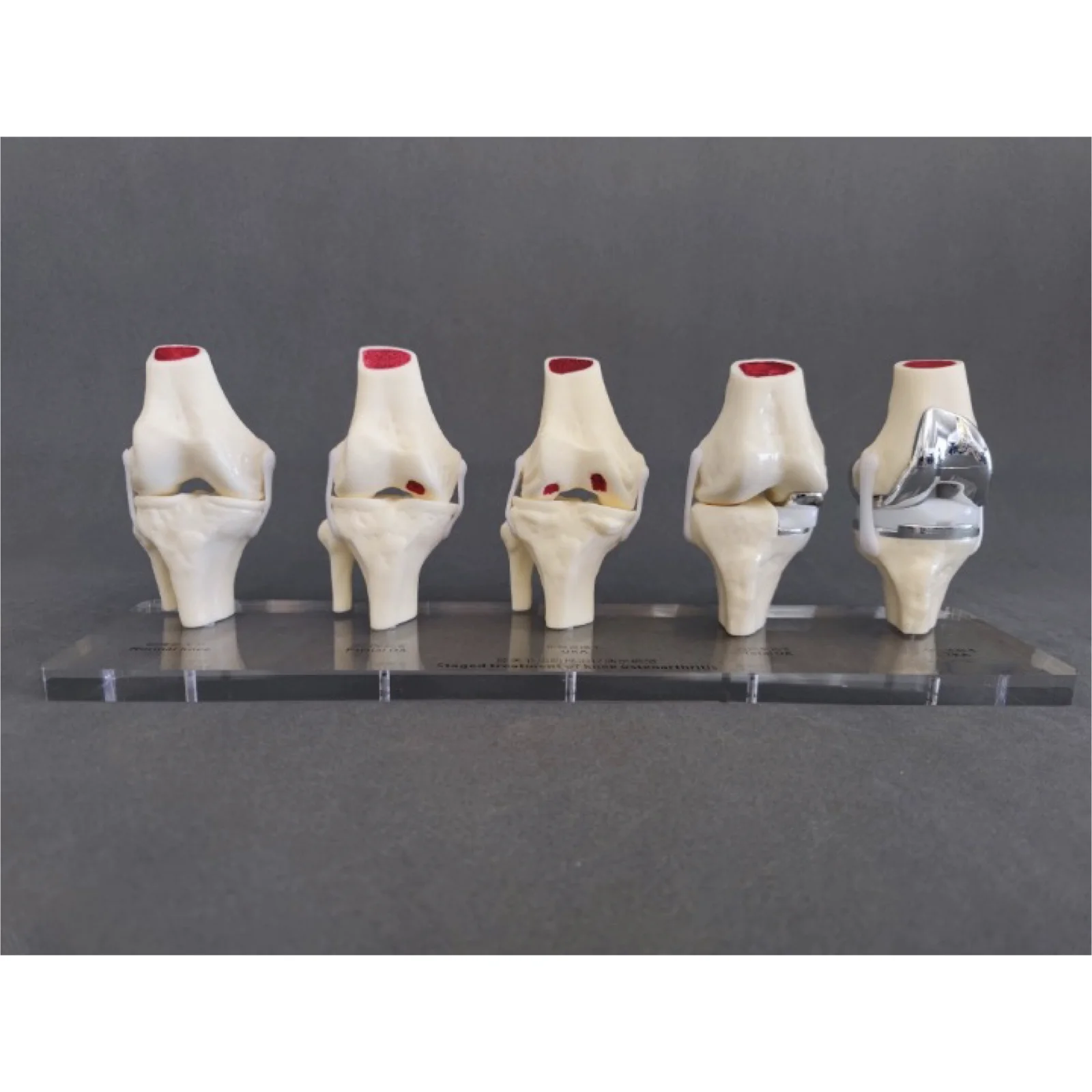 Kyrenmed Knee Osteoarthritis Staircase Treatment Model 5-stage Knee ...