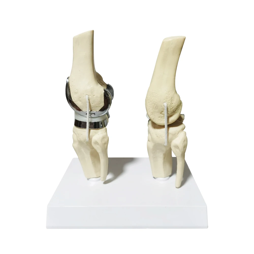 Artificial Knee Joint Model Meniscus Injury Diagnosis Prosthetic Knee ...