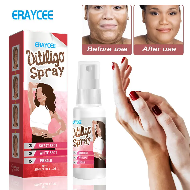 Oem Vitiligo Spray Remove Ringworm White Spot Fade Vitiligo Eliminate ...