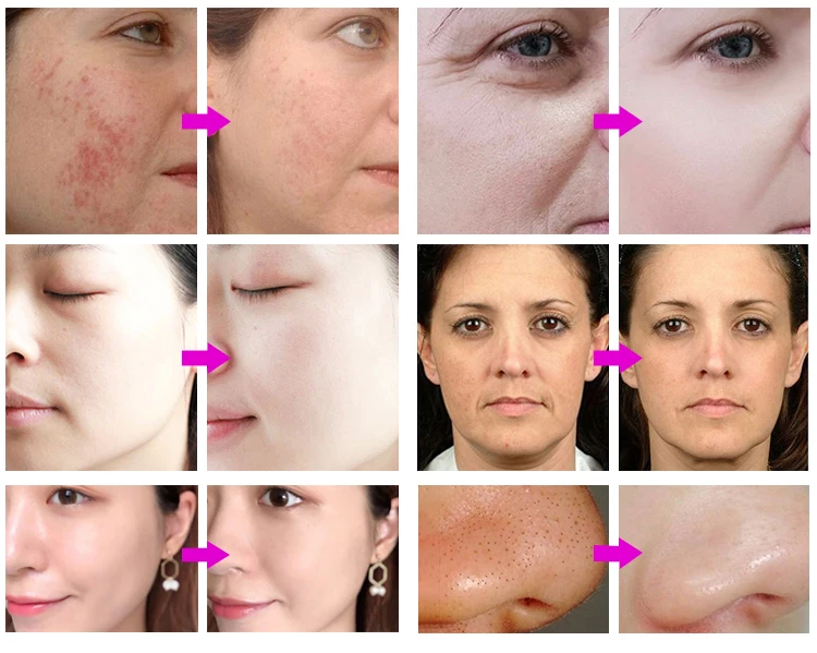 H2O2 Hydro Water Jet Peel Hydrodermabrasion Device 7 En 1 Facial ...