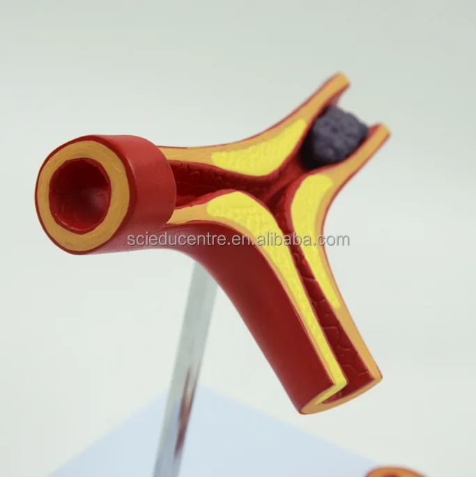 Educational Anatomy Human Arterial Thrombosis and Sclersis Coaching ...