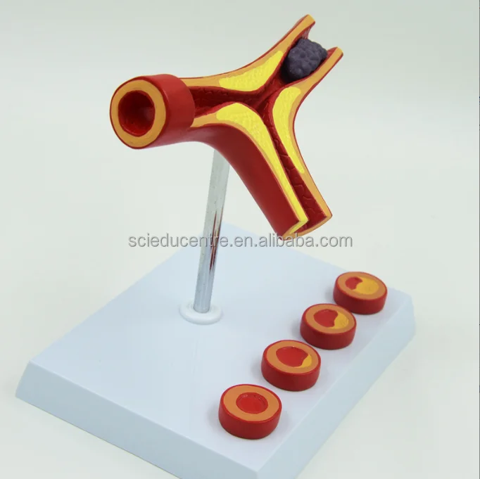 Educational Anatomy Human Arterial Thrombosis and Sclersis Coaching ...