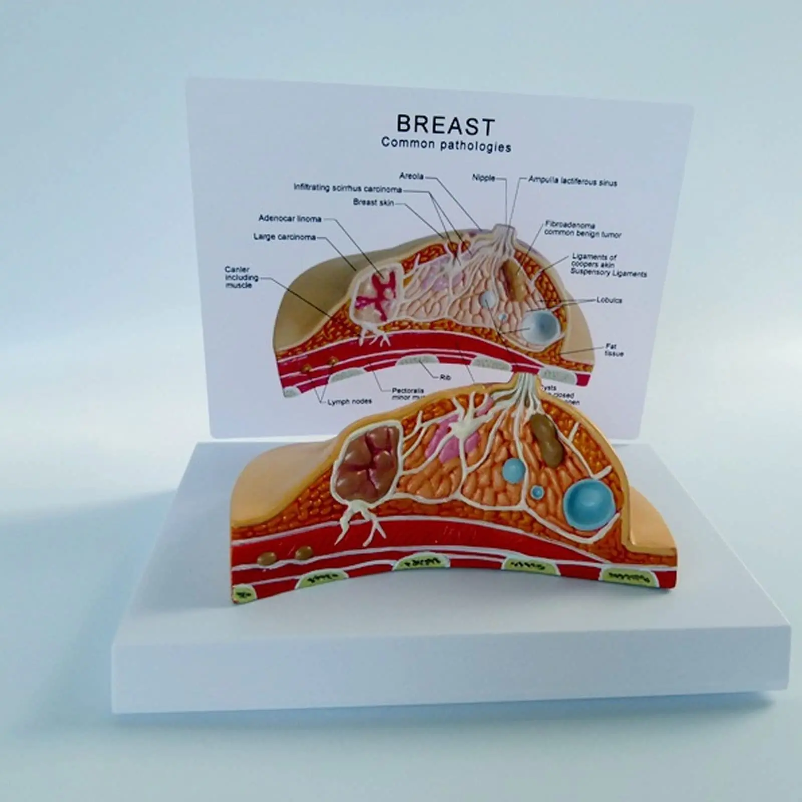 Kyrenmed Female Breast Pathological Anatomy Model
